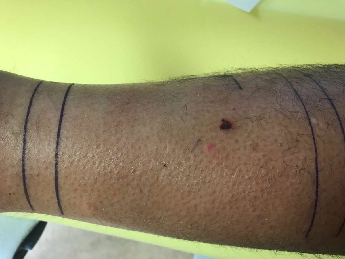 Copperhead snakes take multiple bites out of North Texas man