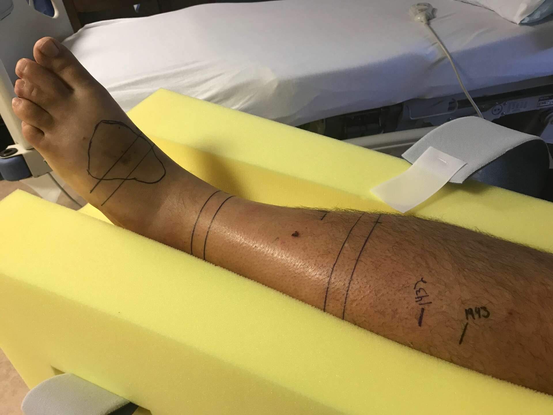 Copperhead Snakes Take Multiple Bites Out Of North Texas Man