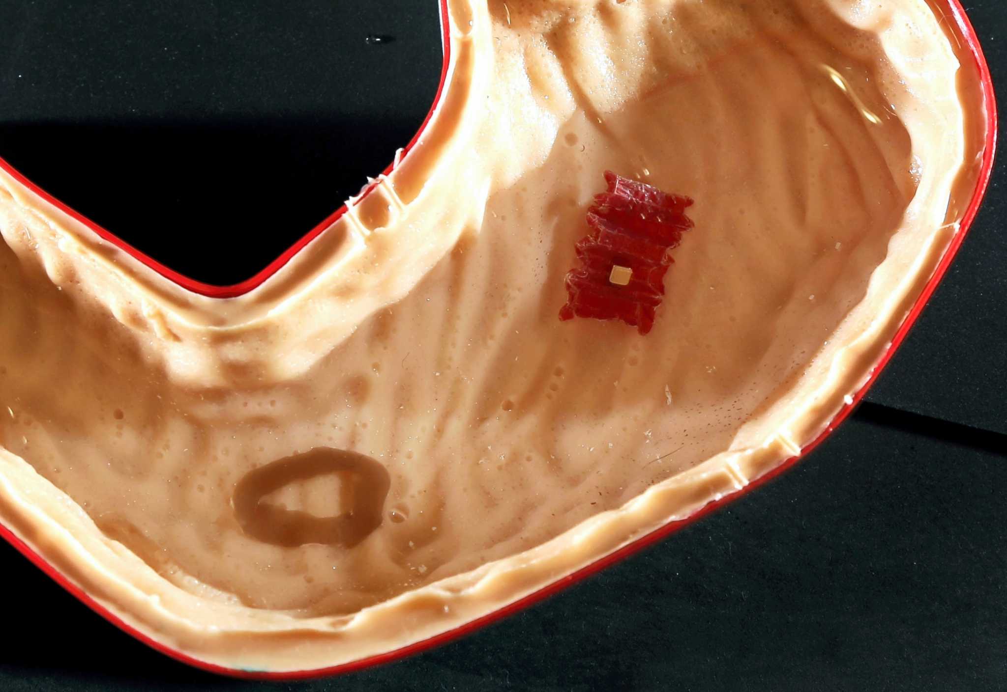 Stomach troubles? Try swallowing an origami robot
