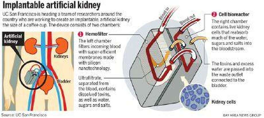 Artificial kidney offers hope to patients tethered to a dialysis ...