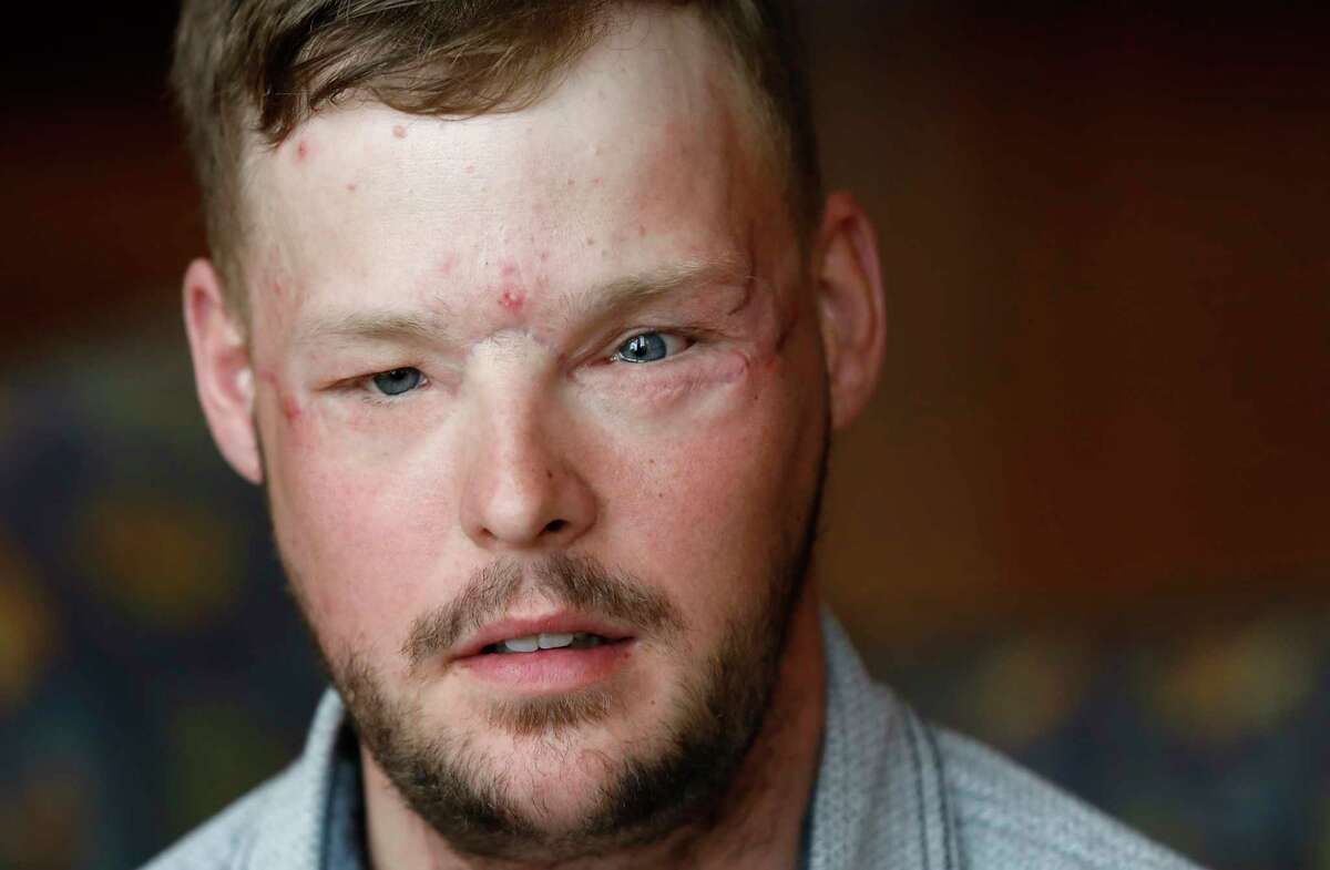 Emotional meeting brings together face transplant recipient, donor's family