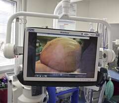 Danbury Hospital surgeons remove woman’s 132-pound tumor