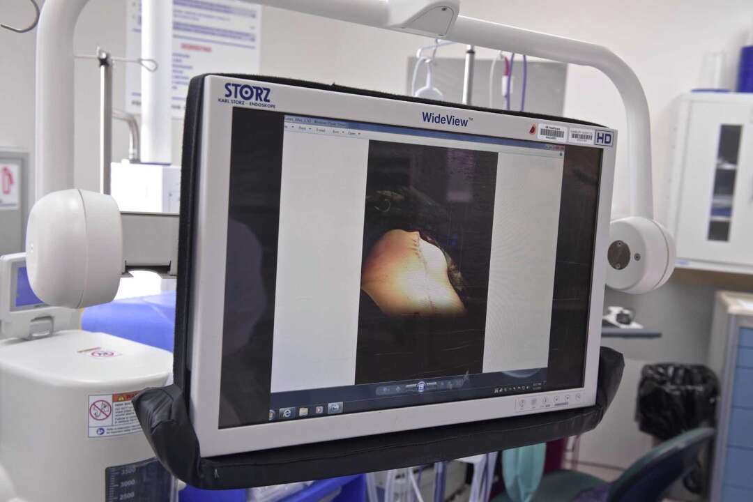 Danbury Hospital surgeons remove woman’s 132-pound tumor
