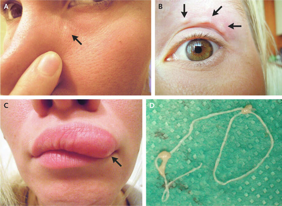 Moving bumps on woman's face turn out to be migrating worm - SFGate