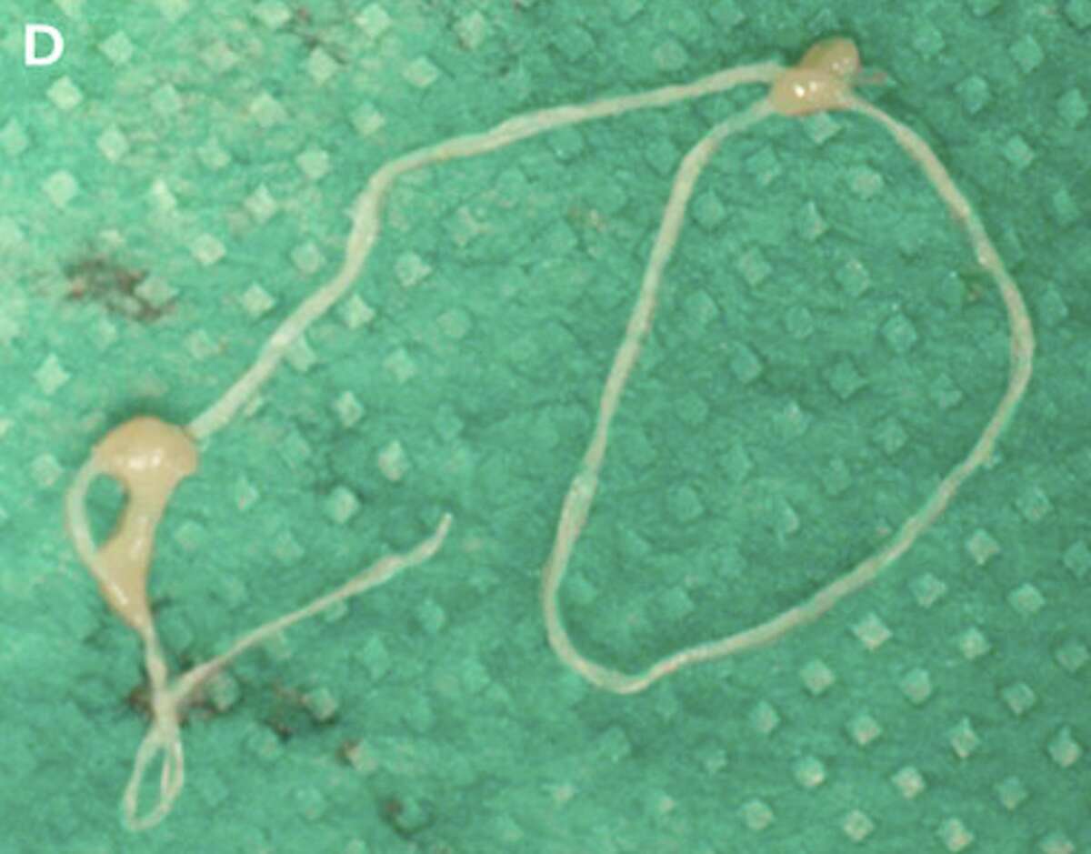 Moving bumps on woman's face turn out to be migrating worm