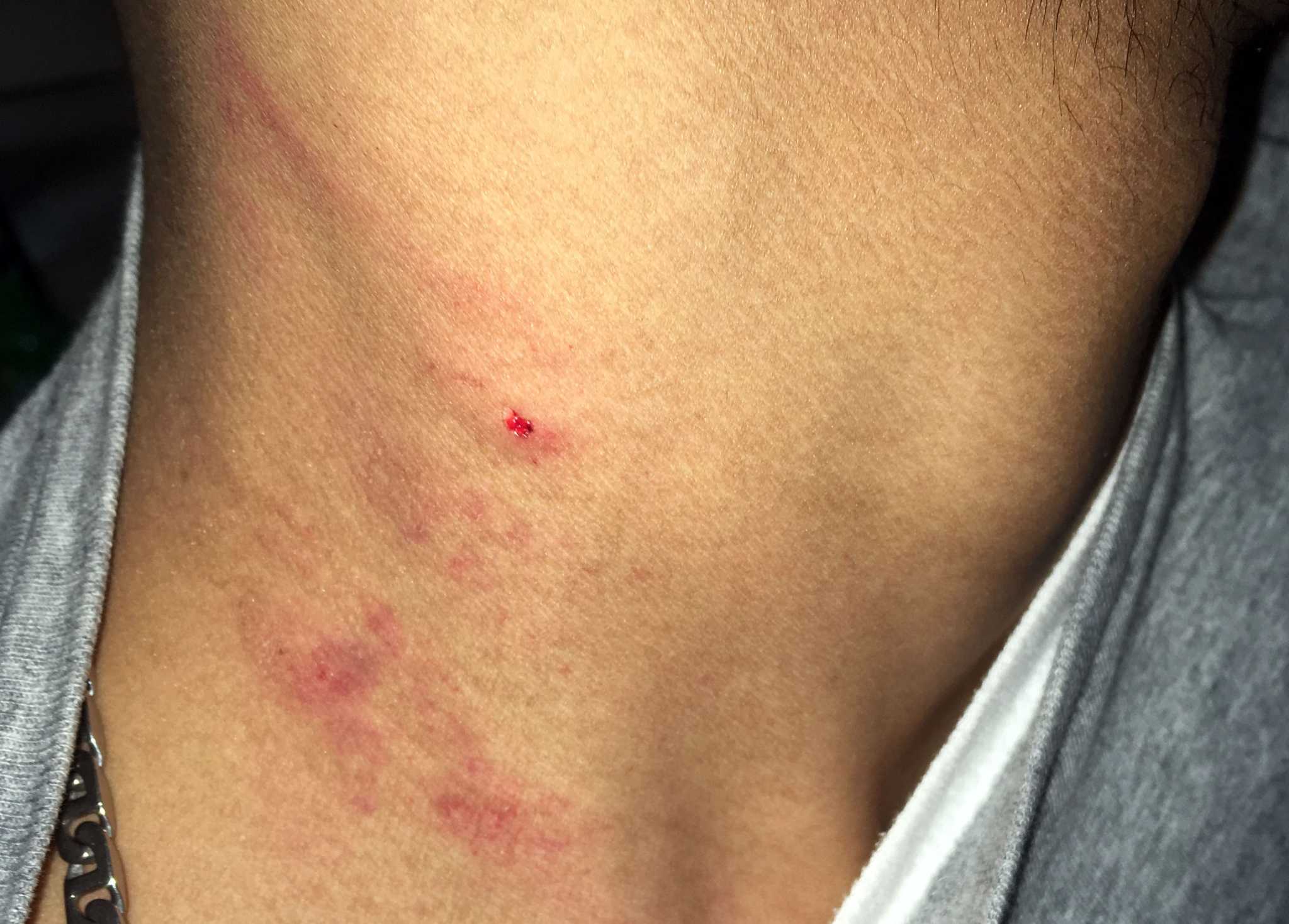 18-year-old releases photos of injuries he says Cohoes mayor inflicted